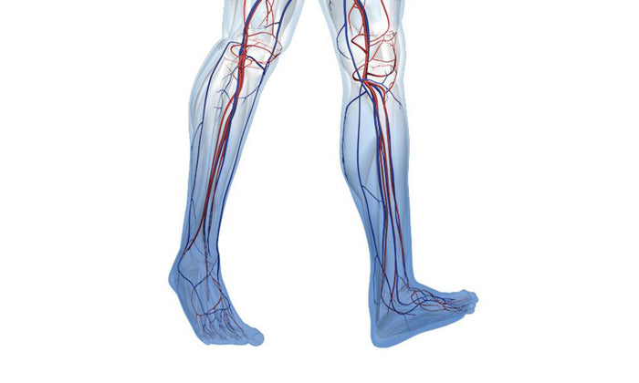 Chronic Venous Insufficiency (CVI) - Causes, Diagnosis and Treatment